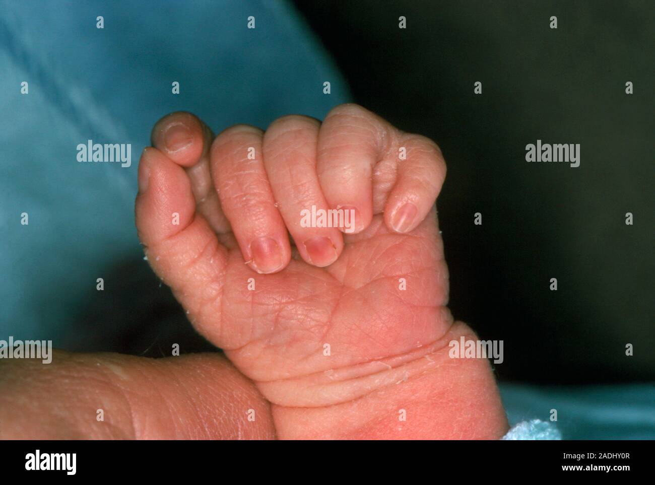 Polydactyly. Close-up of a baby's hand showing an extra finger. This ...