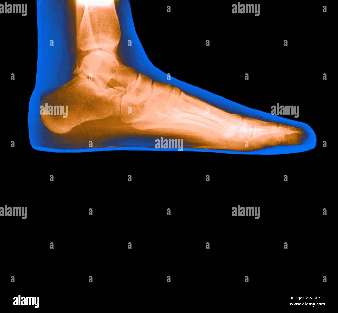 Flat foot. Coloured X-ray of the flat foot of a 25 year old woman. The ...