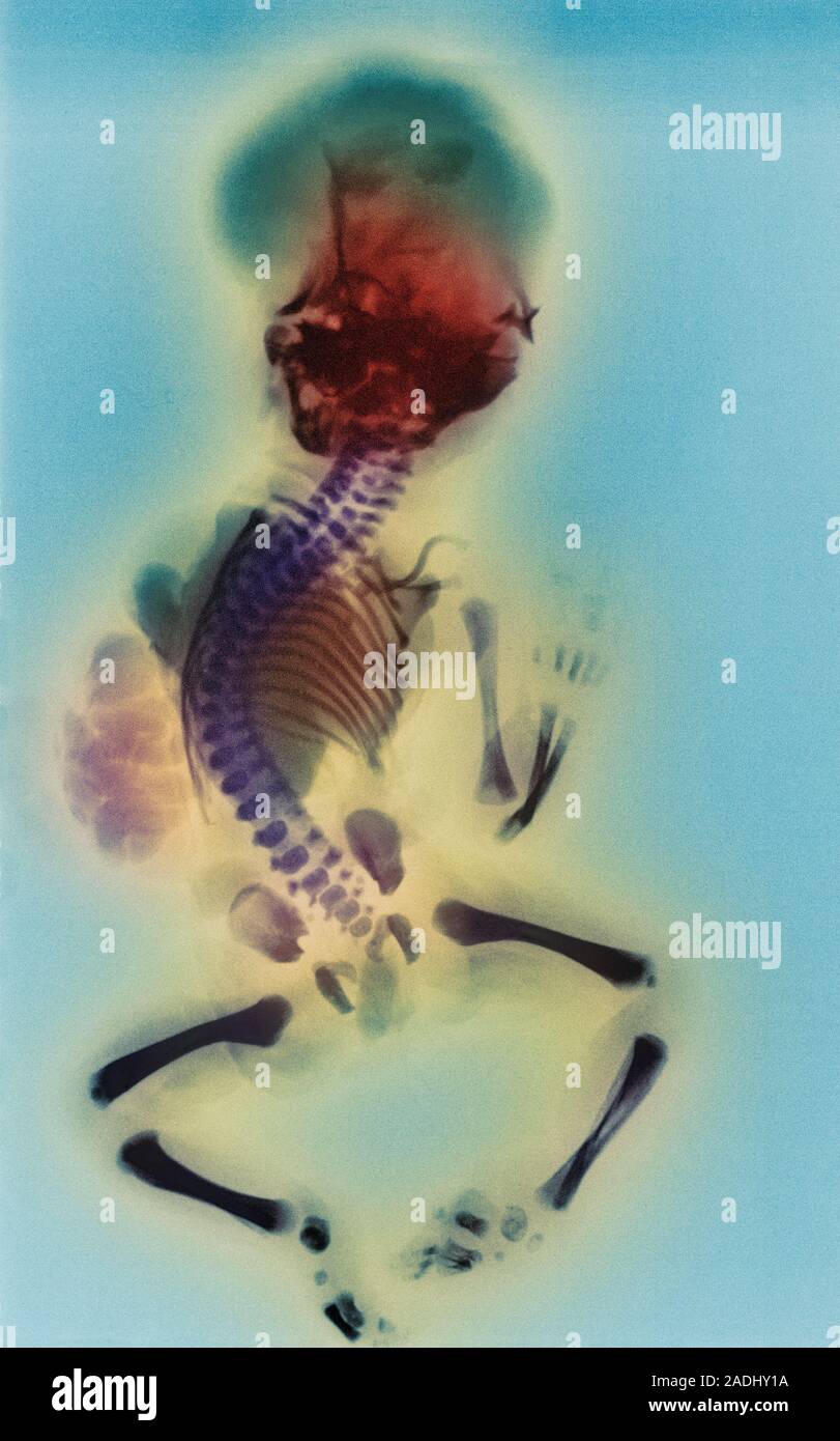 Deformed foetus. Coloured X-ray of a foetus with multiple deformities ...