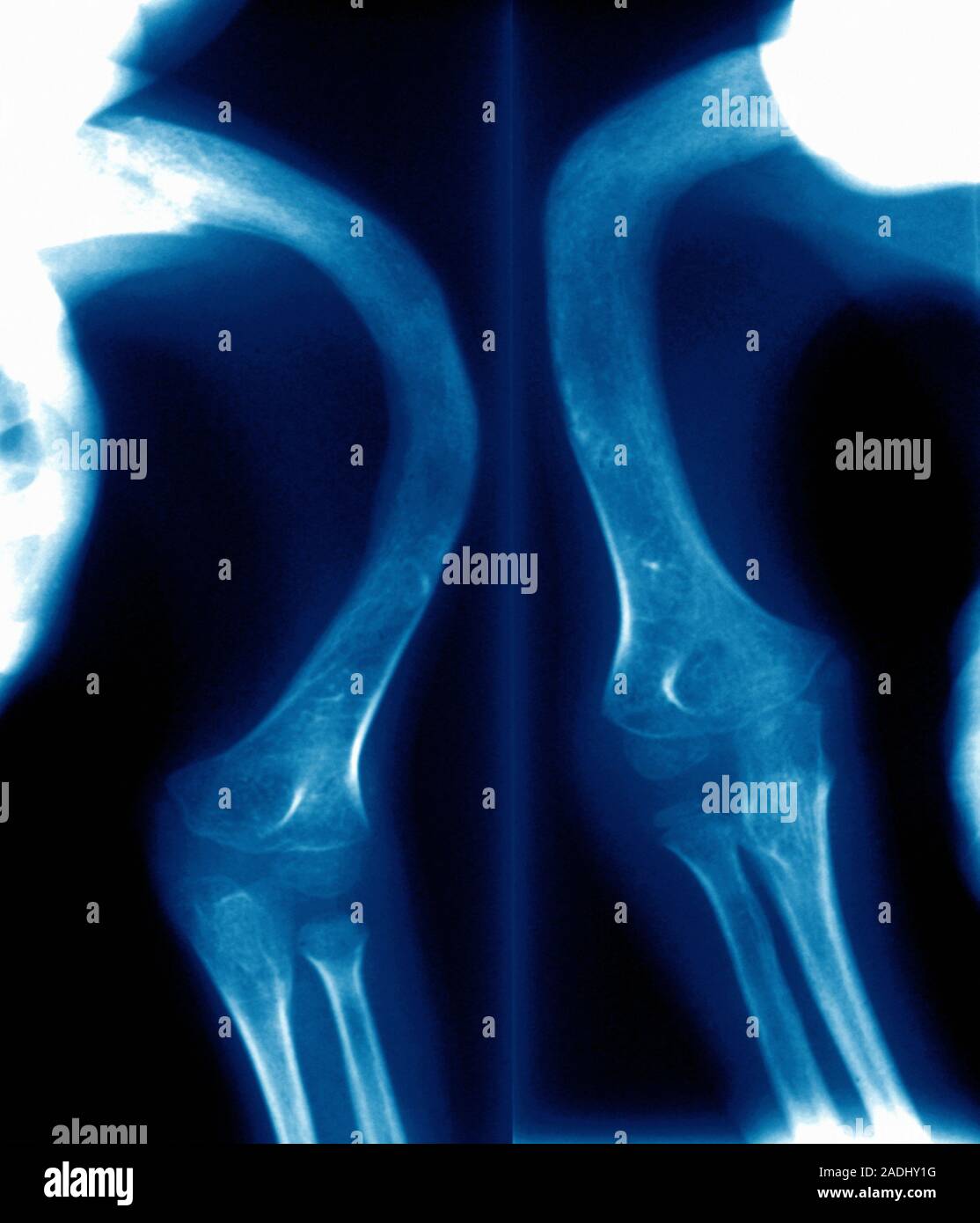 Deformed upper arm bones. Coloured X-rays of the left (left) and right ...