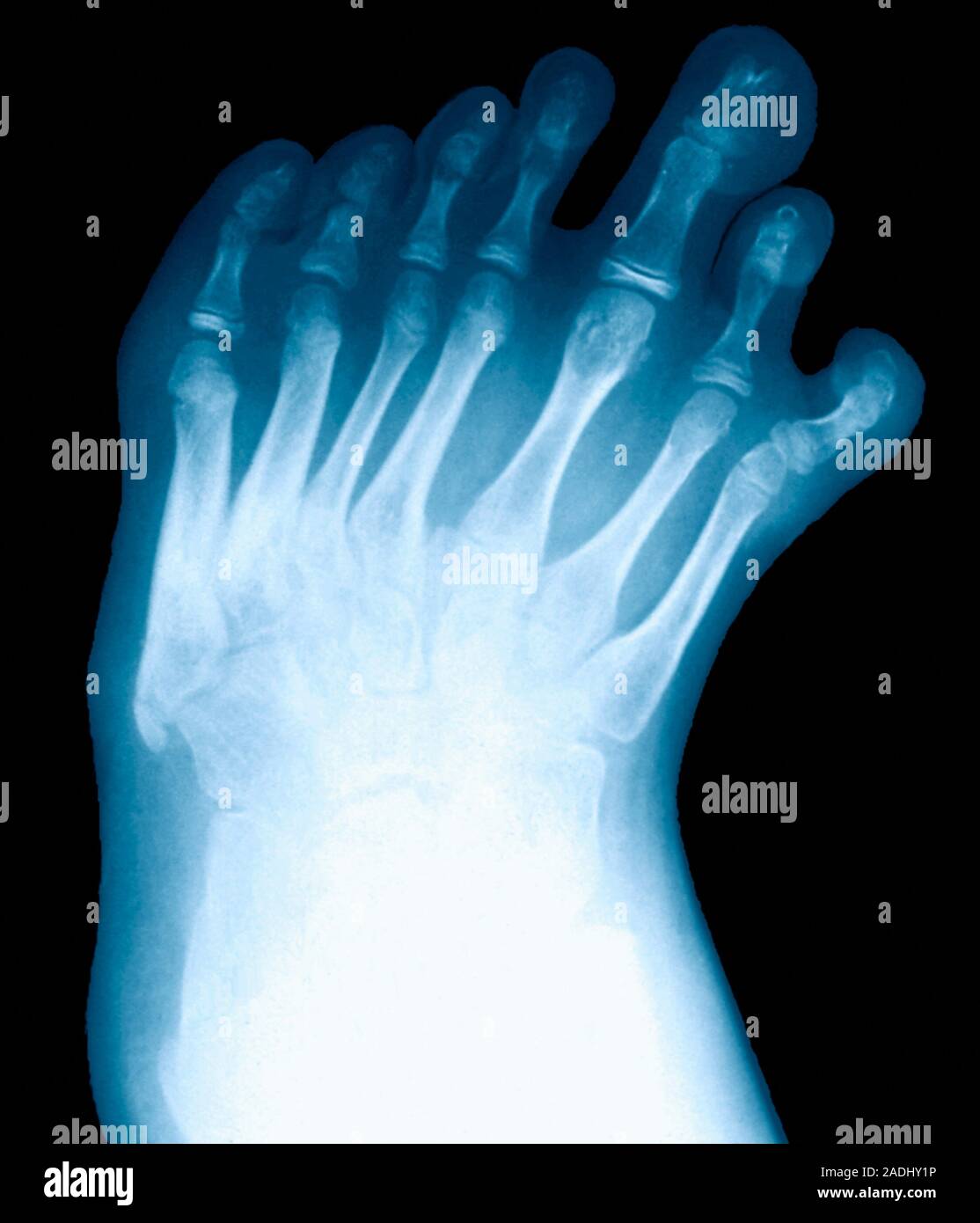 Seven-toed foot. X-ray of a child's foot showing polydactyly, a ...