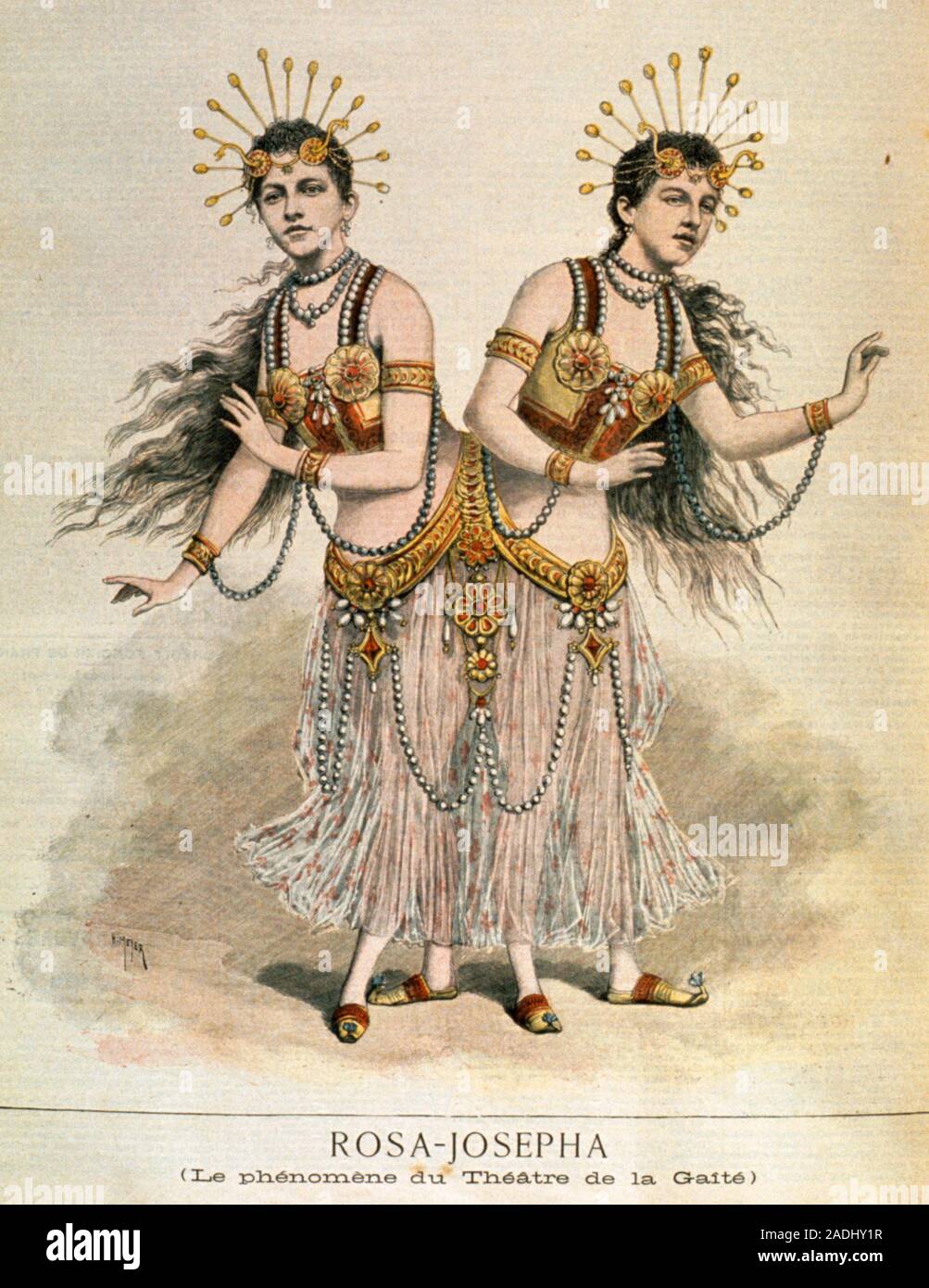 Conjoined twins. Historical artwork of conjoined twins Rosa and Josepha ...