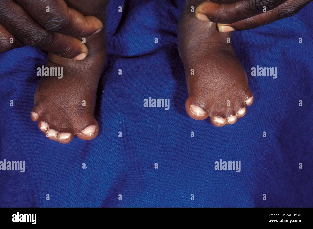 Webbed feet. This webbing (syndactyly) between a baby's toes is due to ...