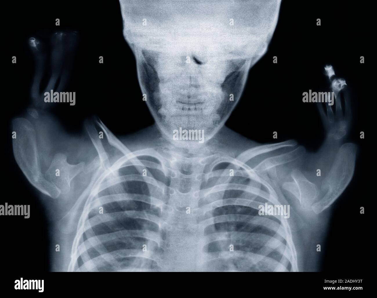 Thalidomide baby. X-ray of the upper chest and head of a baby with ...
