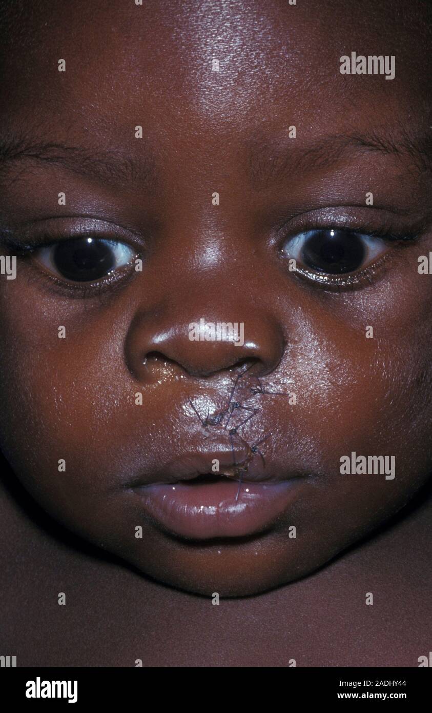 MODEL RELEASED. Cleft lip. Image 2 of 2. Baby's face after surgery to ...