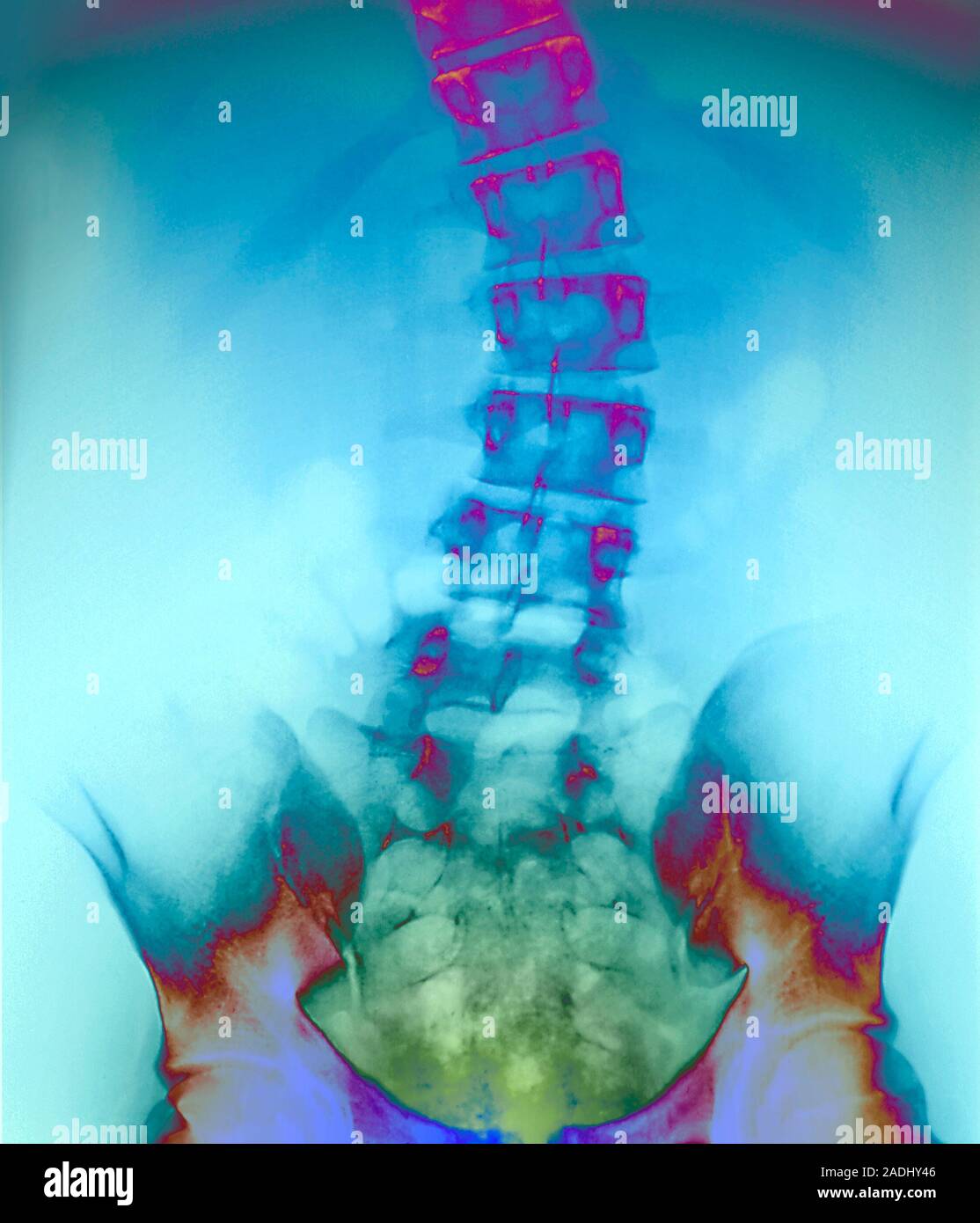 Scoliosis. Coloured X-ray of the abdomen of an adolescent girl with ...