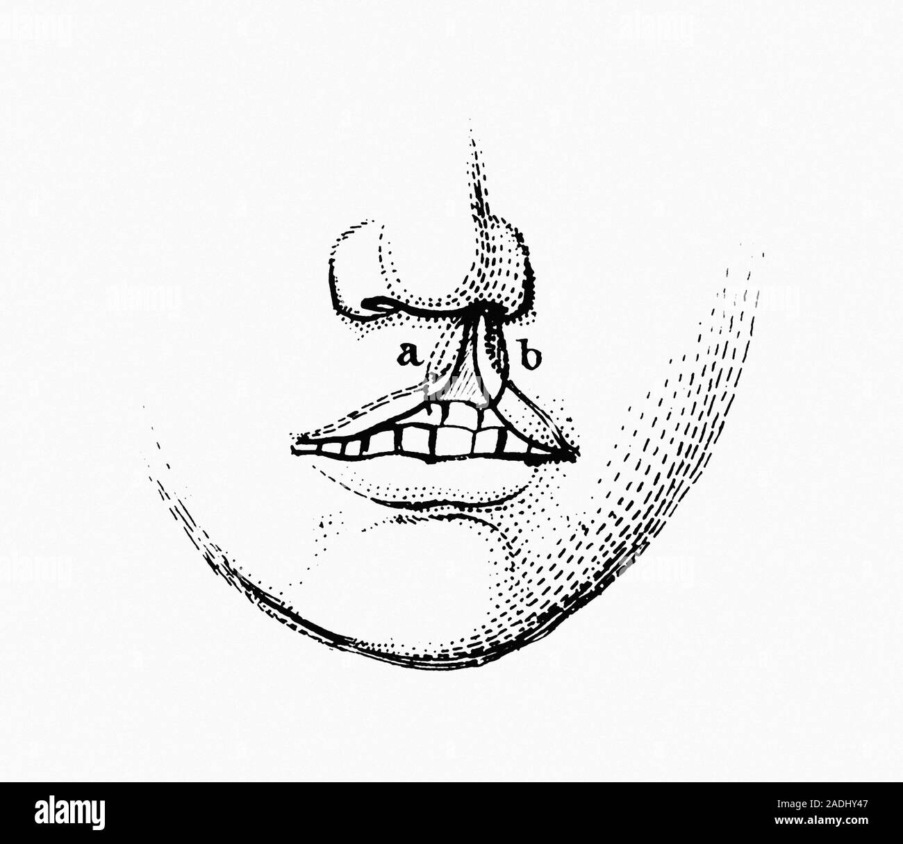 Cleft lip. Image 1 of 2. Artwork of the face of a person with a cleft ...