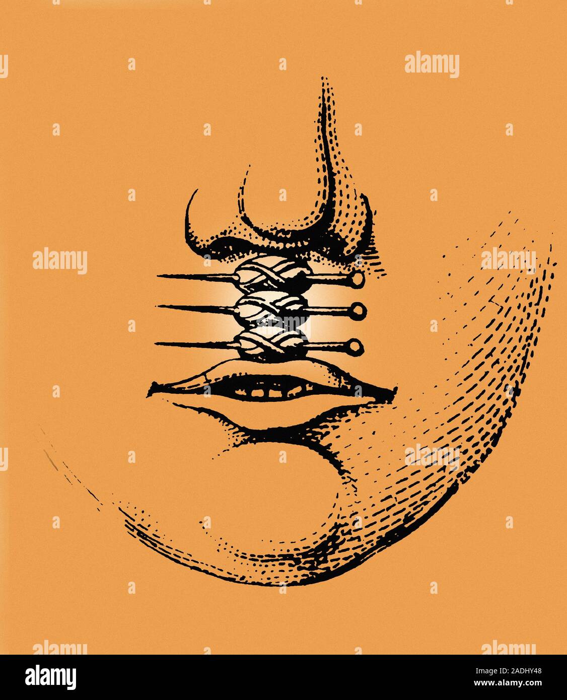 Cleft lip. Image 2 of 2. Artwork of the face of a person with a cleft ...