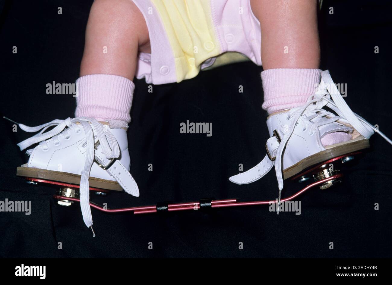 Clubfoot (talipes equinovarus) being treated with splints. The patient ...