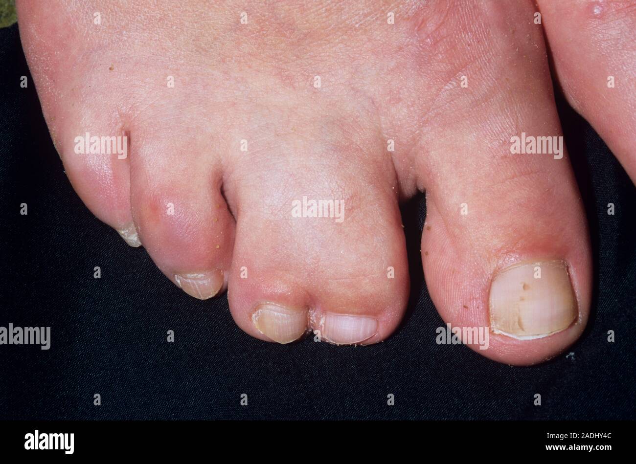 Webbed toes of a 32-year-old woman. This congenital (present from birth ...