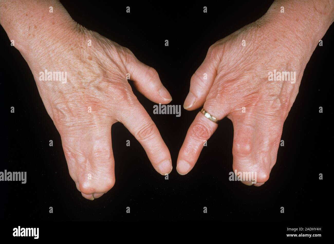 Webbed fingers. This congenital (present from birth) fusion of the ...