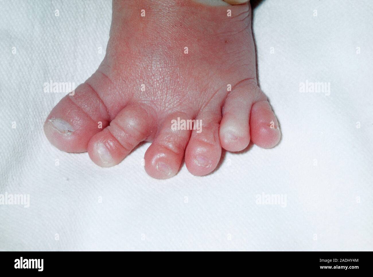 Six-toed foot of a baby. Having more than five fingers or toes is known ...