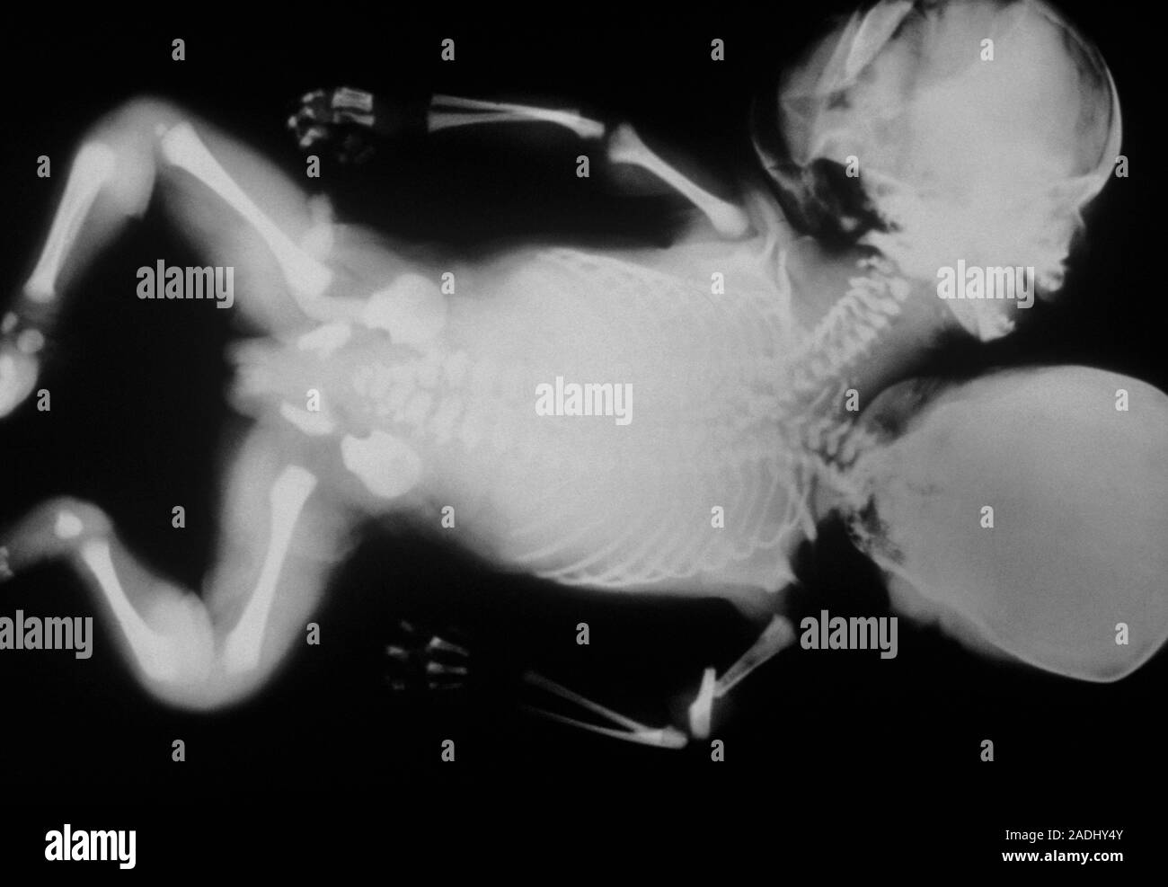 Two-headed infant. X-ray of conjoined (siamese) twins. Each twin has ...