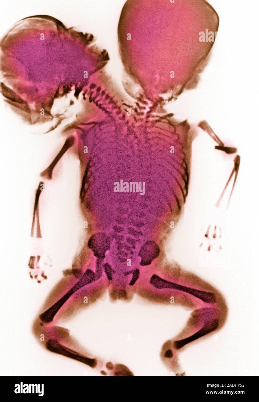 Two-headed infant. Coloured X-ray of conjoined (siamese) twins. Each ...