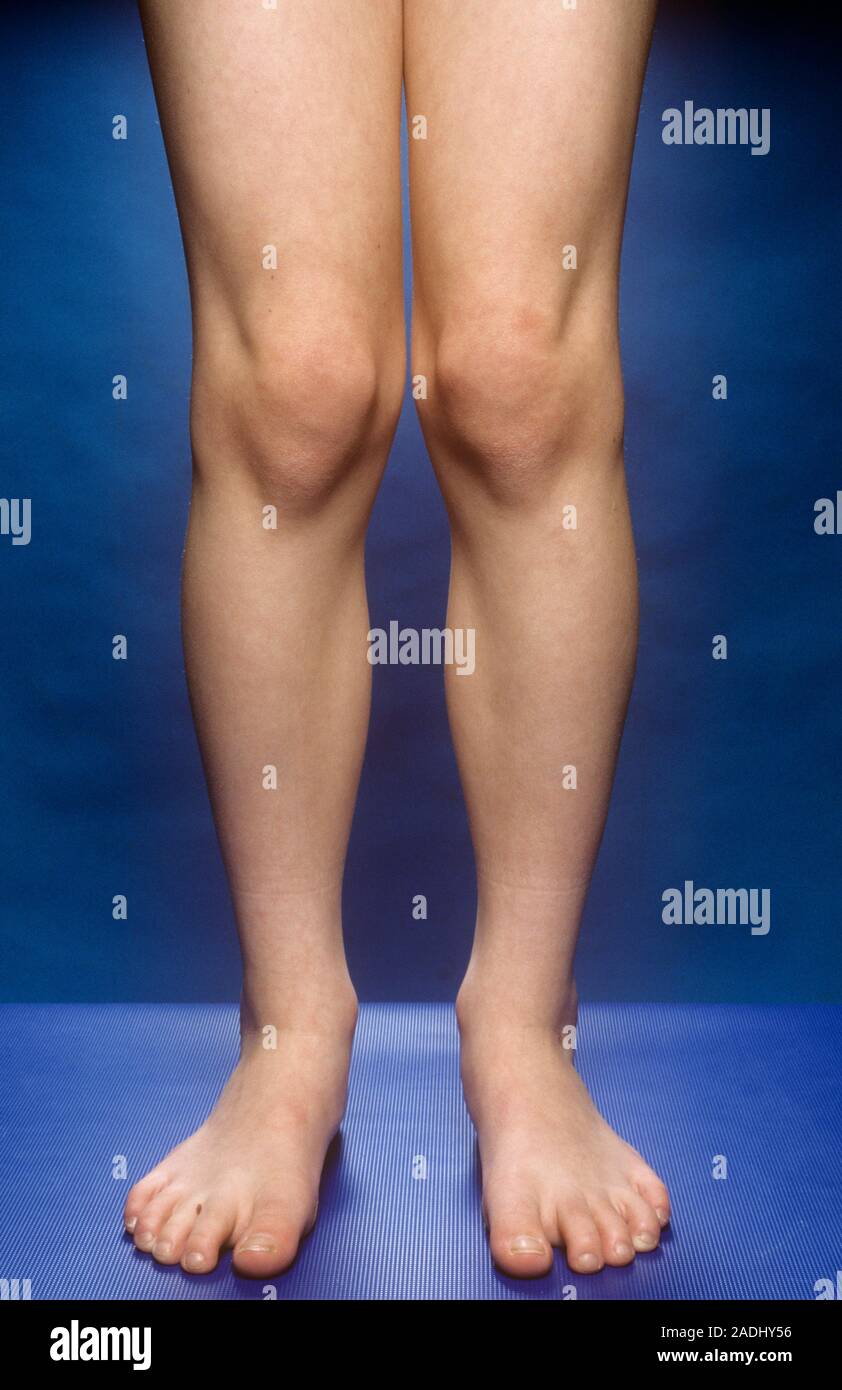 Knock-knees. Legs of a knock-kneed patient, caused by internally ...