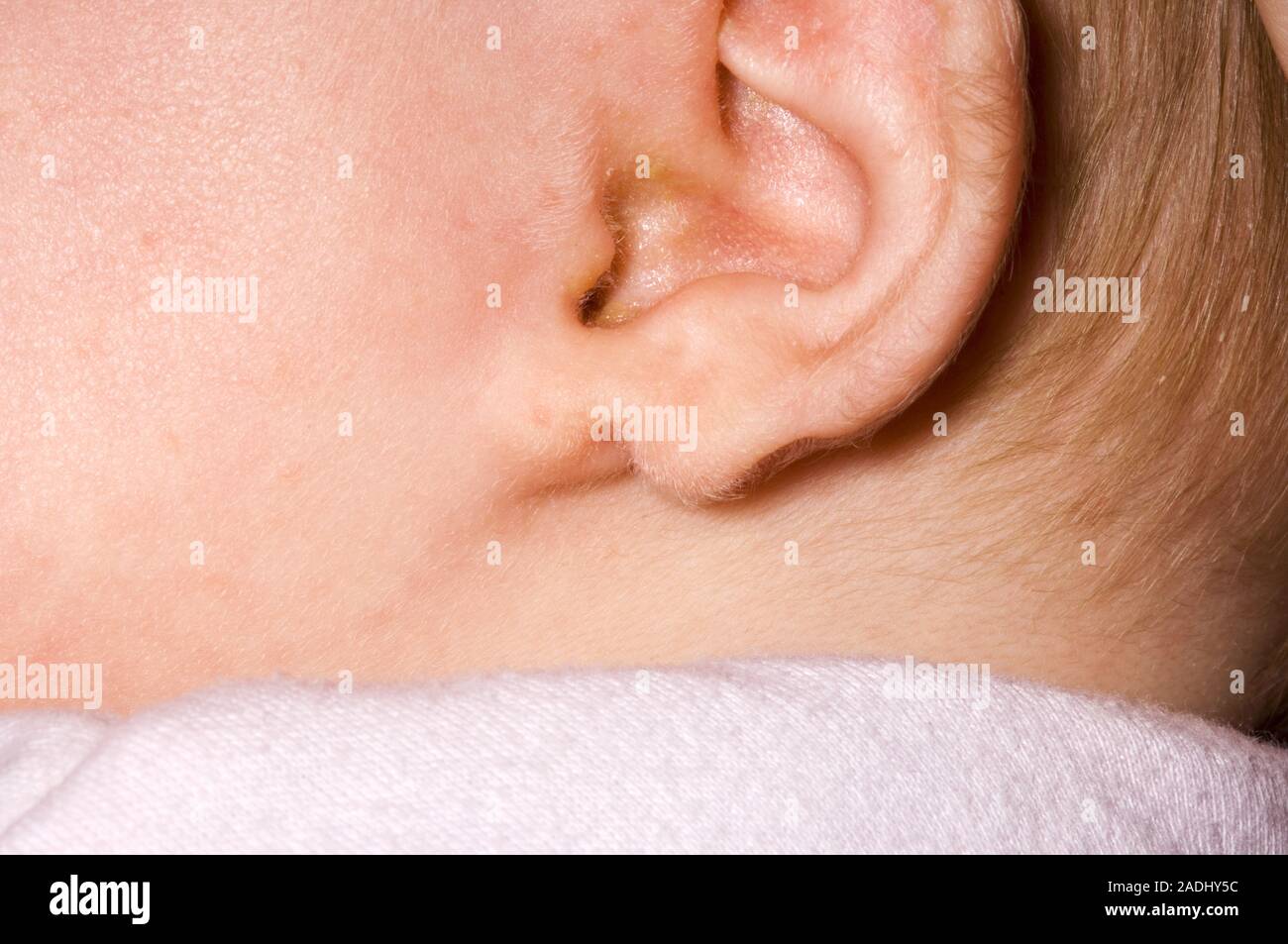 Congenital split ear lobe of a 6- week-old baby girl. A congenital ...