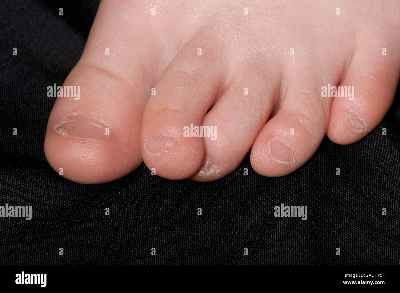 Overlapping toes on the foot of a 4 year old boy. This is a congenital ...