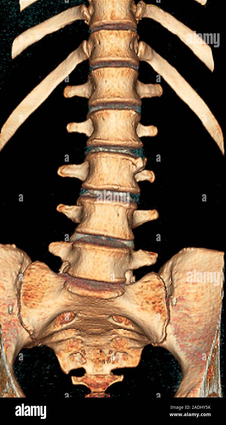 Spinal bone protrusion. Coloured 3D CT (computed tomography) scan of ...