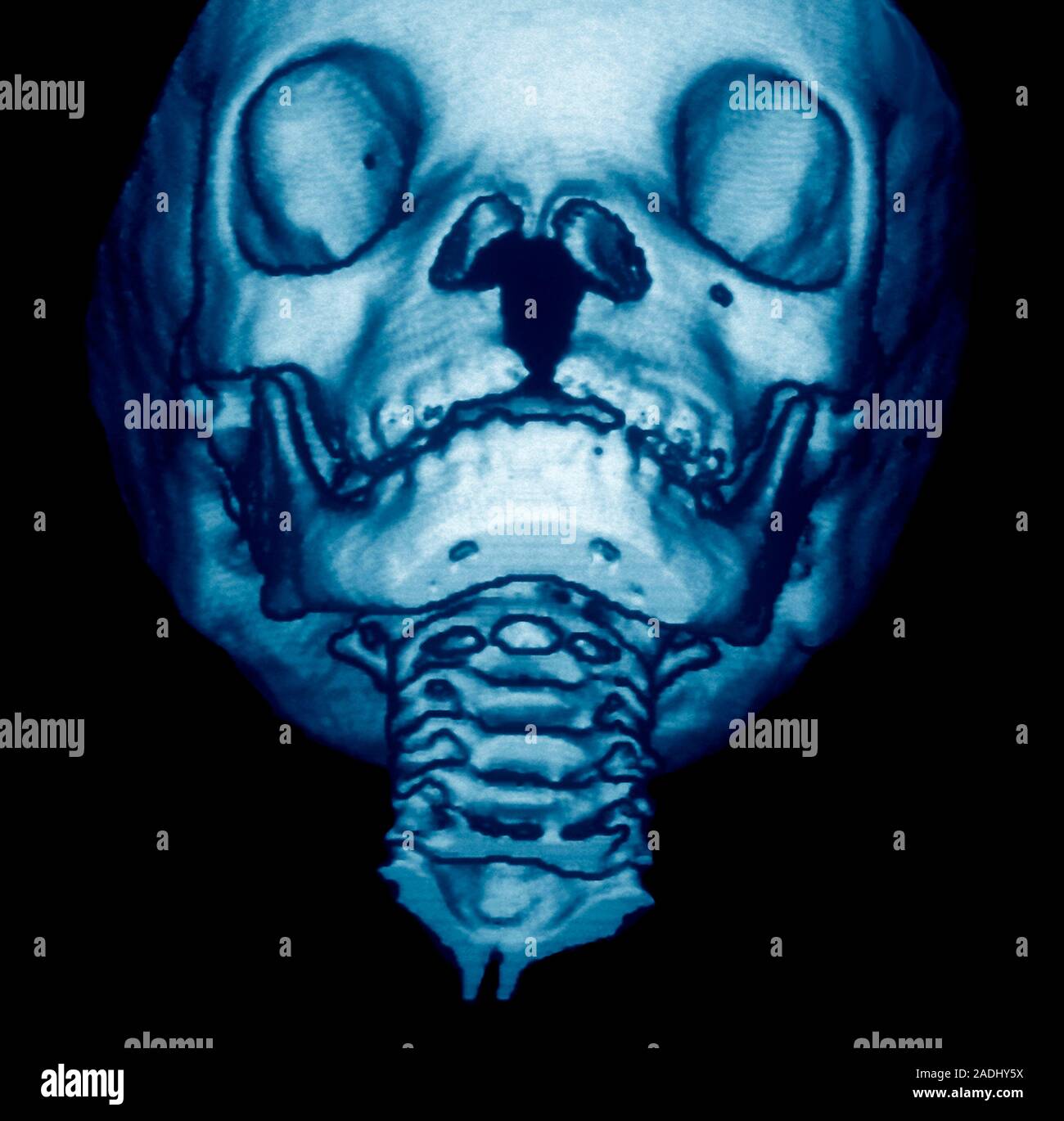Cleft lip. Coloured 3D computed tomography (CT) scan of the skull of a ...