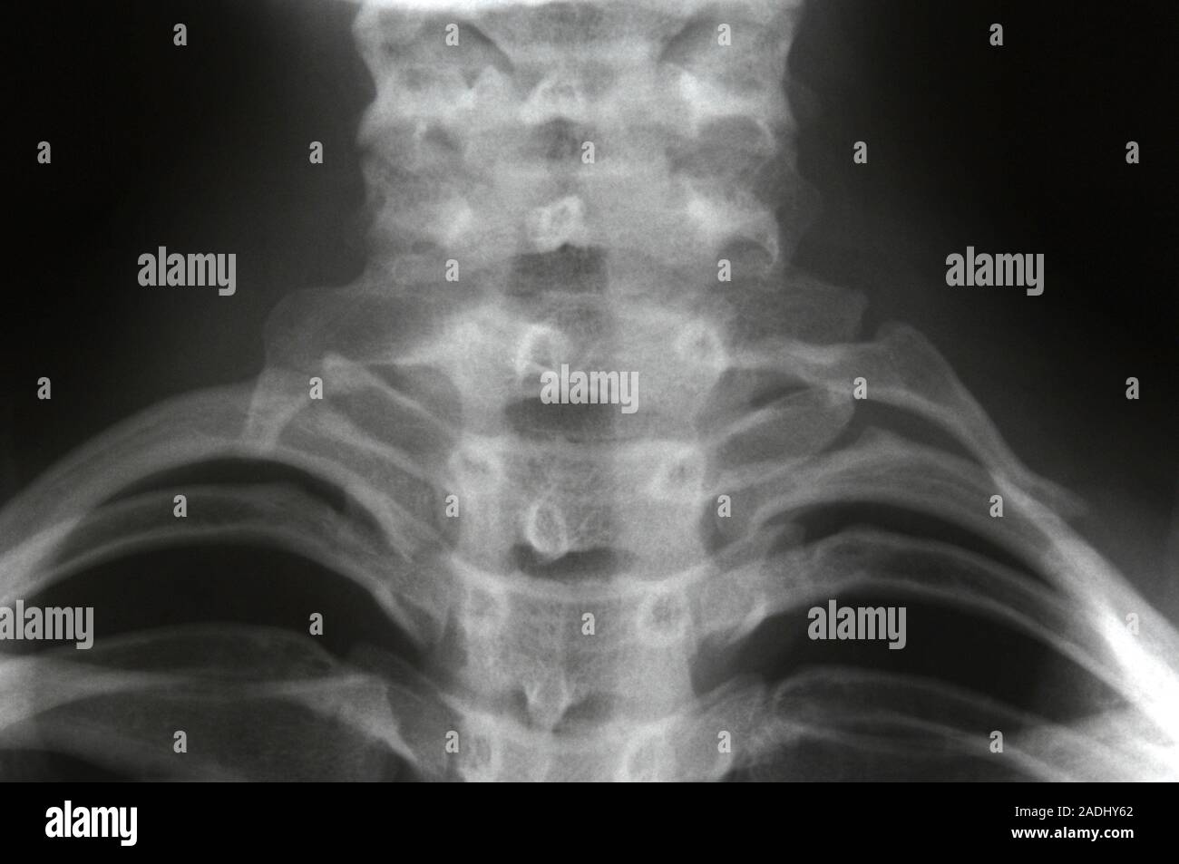 MODEL RELEASED. Cervical ribs. X-ray of the neck of a 13 year old girl ...