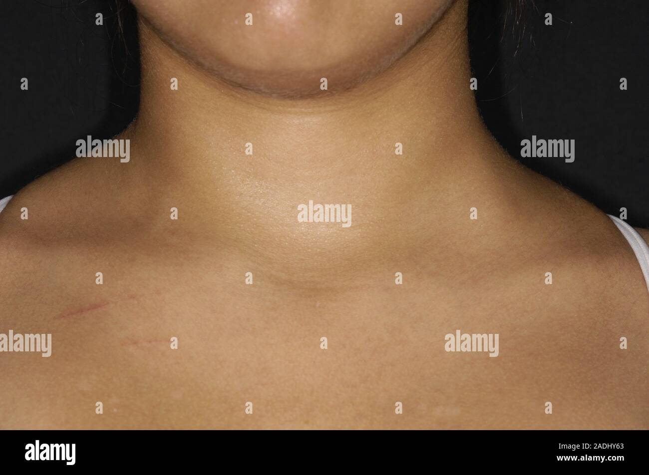 Cervical Ribs 13 Year Old Girl Exhibiting The Congenital From Birth Abnormality Of Extra Ribs