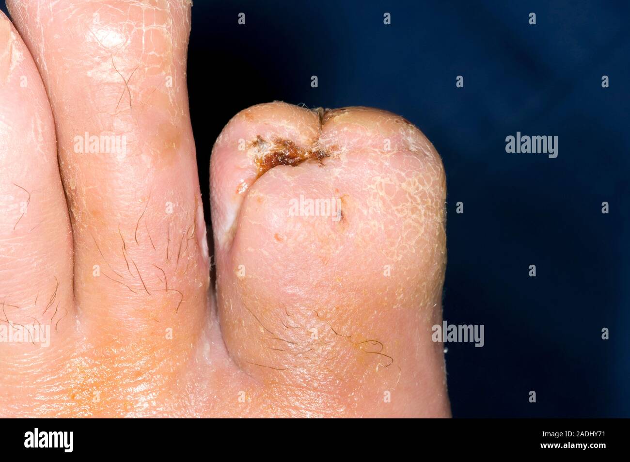 Amputated toe. Big toe of a 60 year old man with type 2 diabetes ...