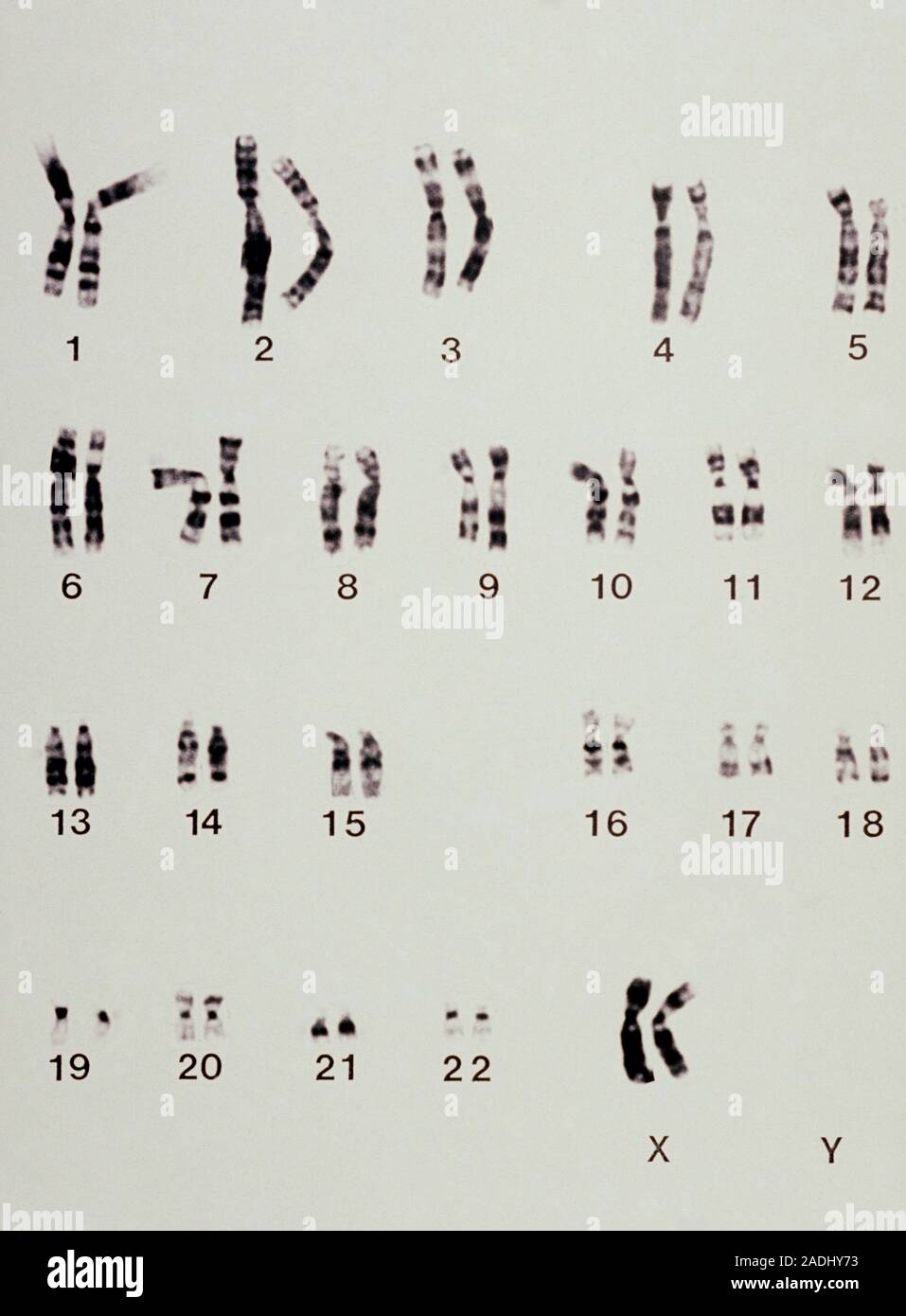 Karyotype showing the arrangement of chromosomes in a female with Cri ...