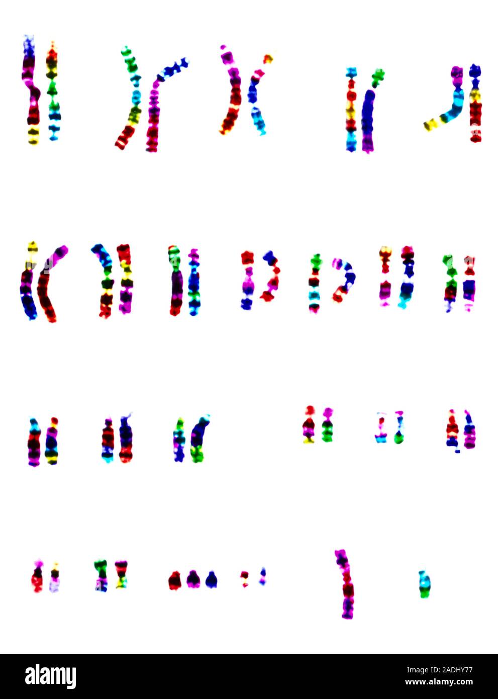 Down's syndrome. Coloured karyotype of the chromosomes in a male with ...