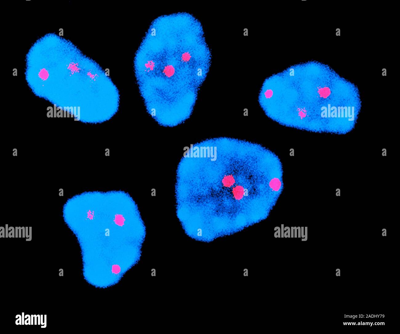 Down's syndrome diagnosis. Fluorescence in situ hybridisation (FISH ...