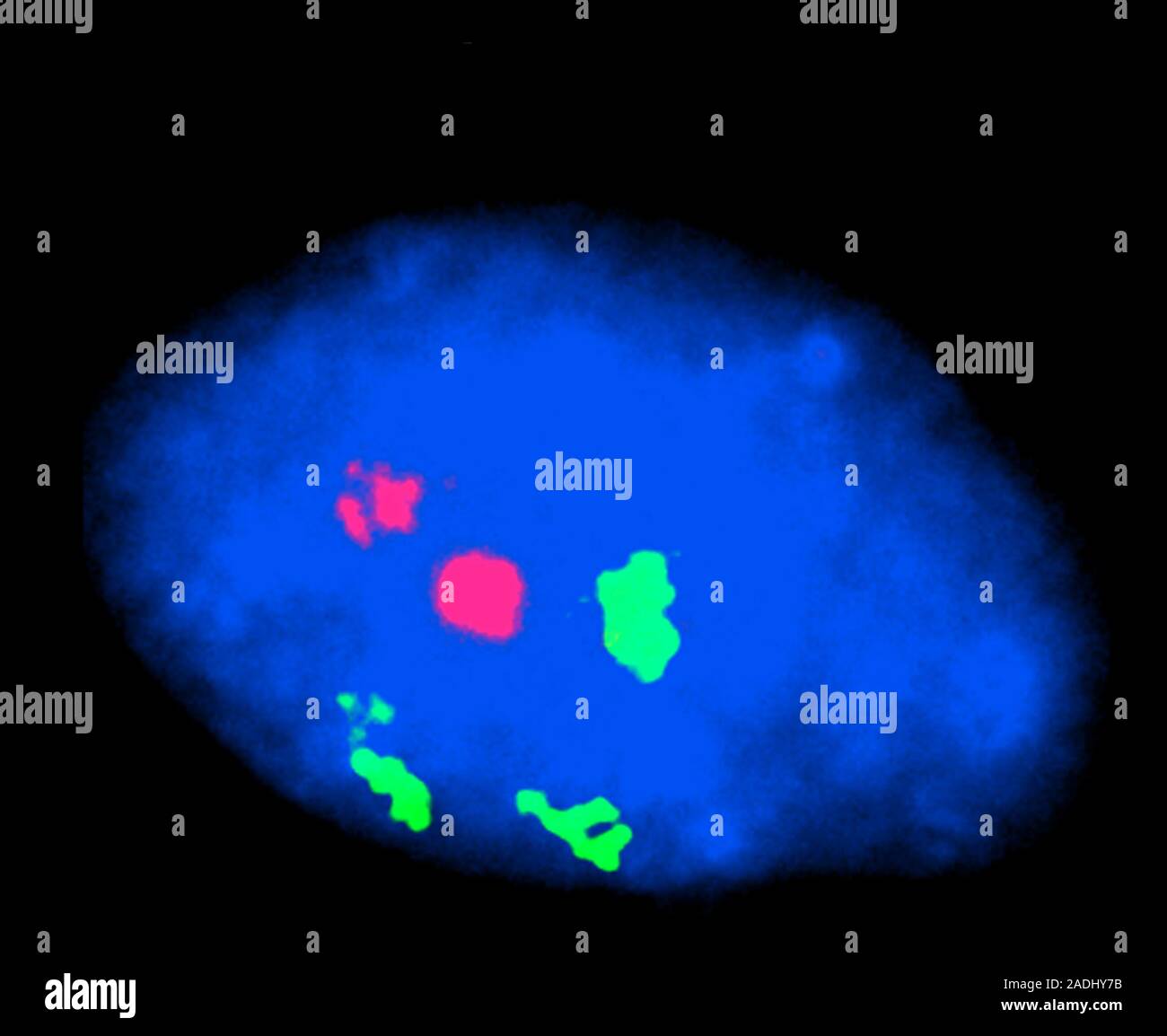 Trisomy 18 diagnosis. Fluorescence in situ hybrid- isation (FISH ...