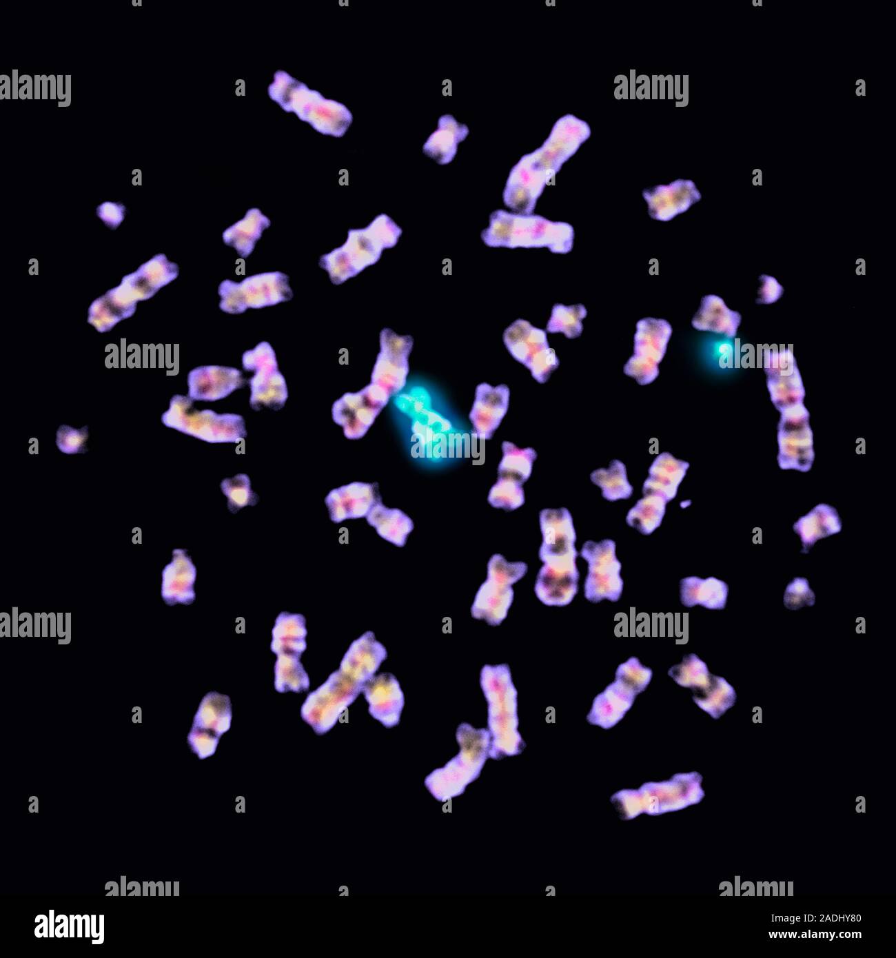 Philadelphia chromosome. Coloured light micrograph of a karyotype ...