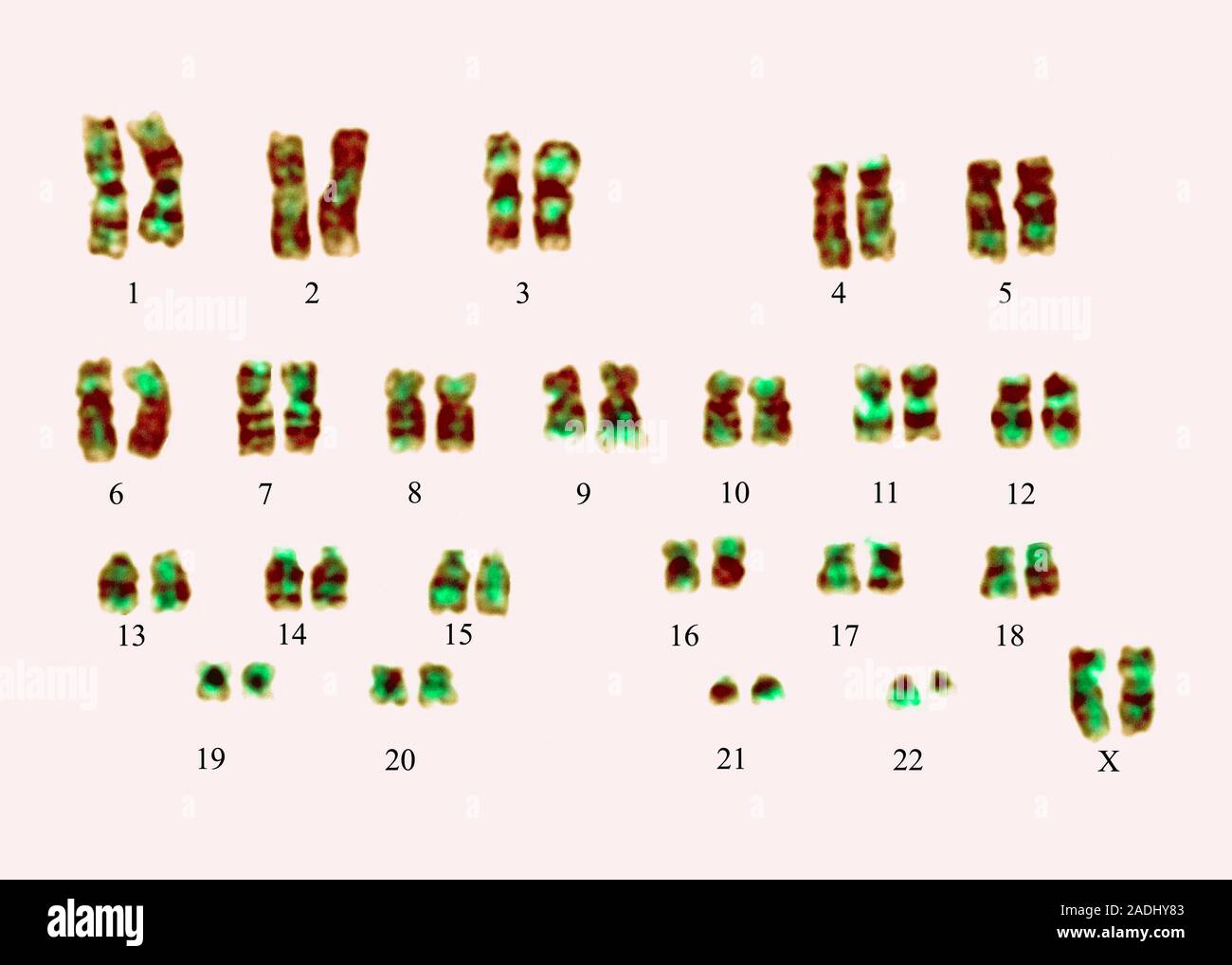 Philadelphia chromosome. Coloured light micrograph of a female ...