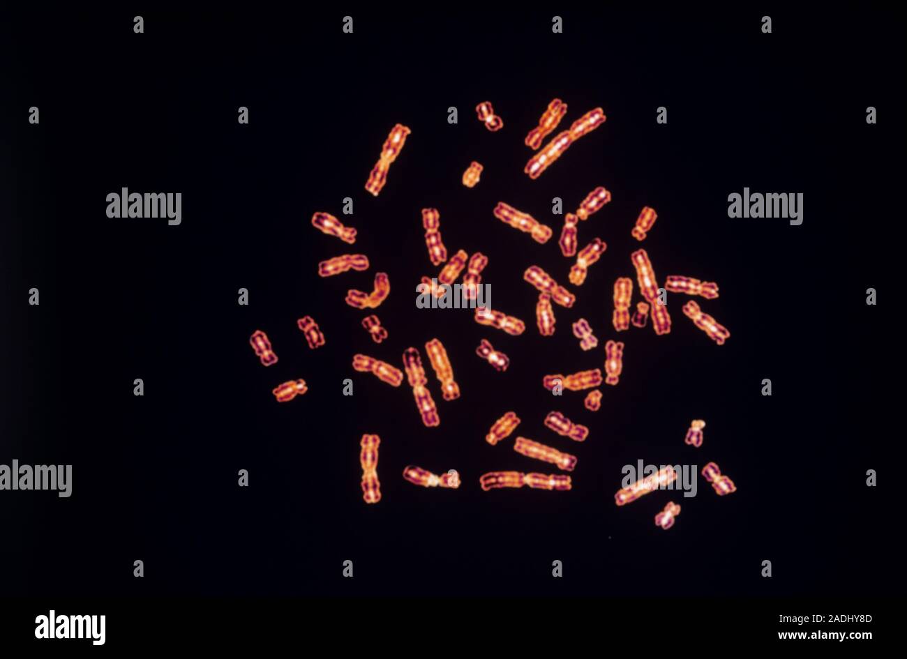 Kleinfelter syndrome. Light micrograph of a karyotype (set of ...