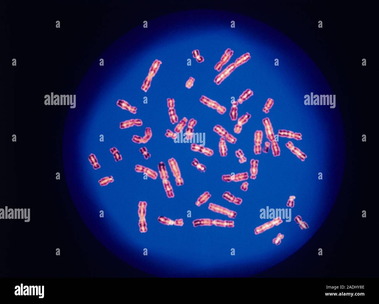 Kleinfelter syndrome. Light micrograph of a karyotype (set of ...