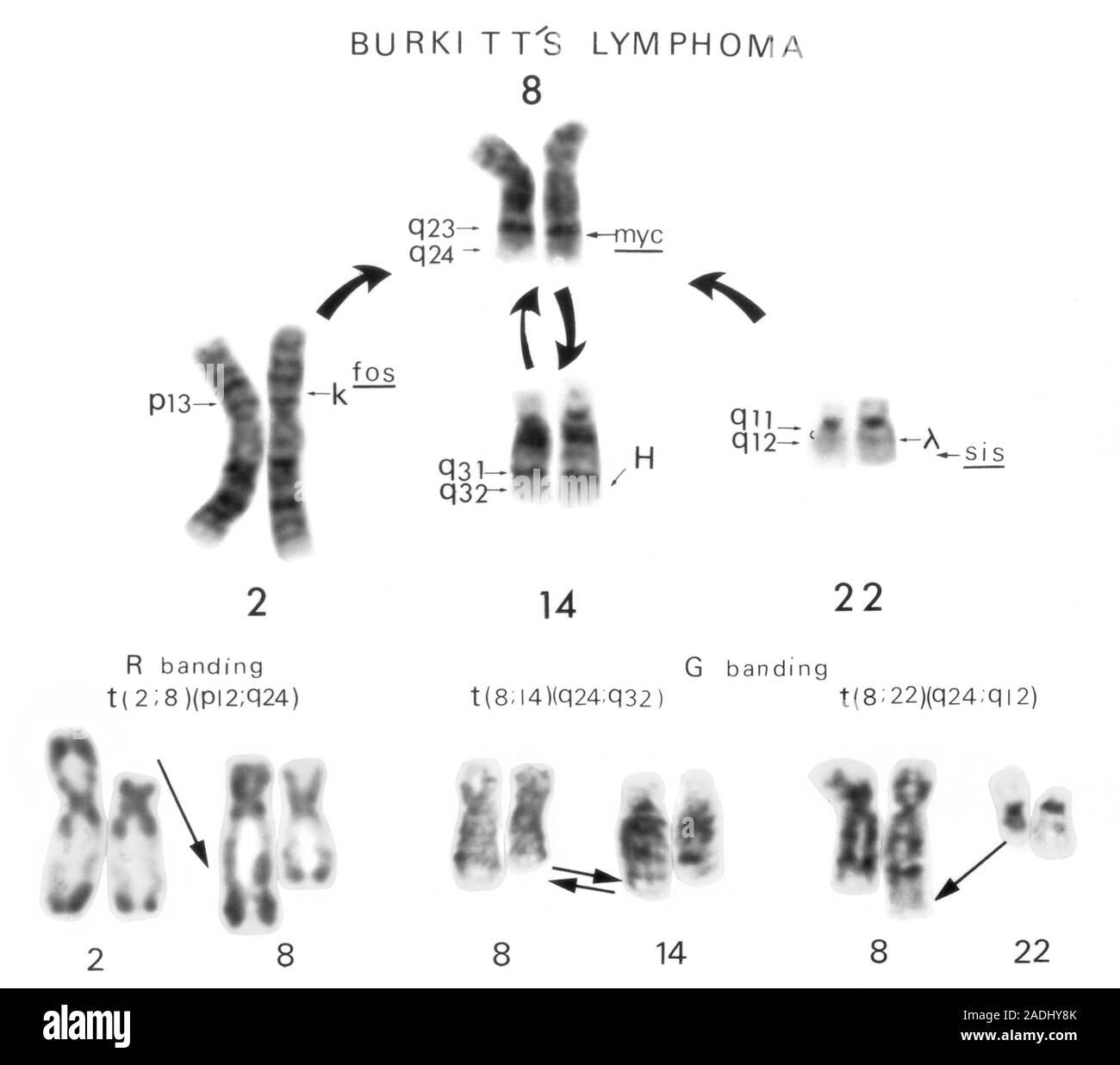 Burkitt's lymphoma. Diagram of the translocations, the abnormal transfer of sections of DNA ...