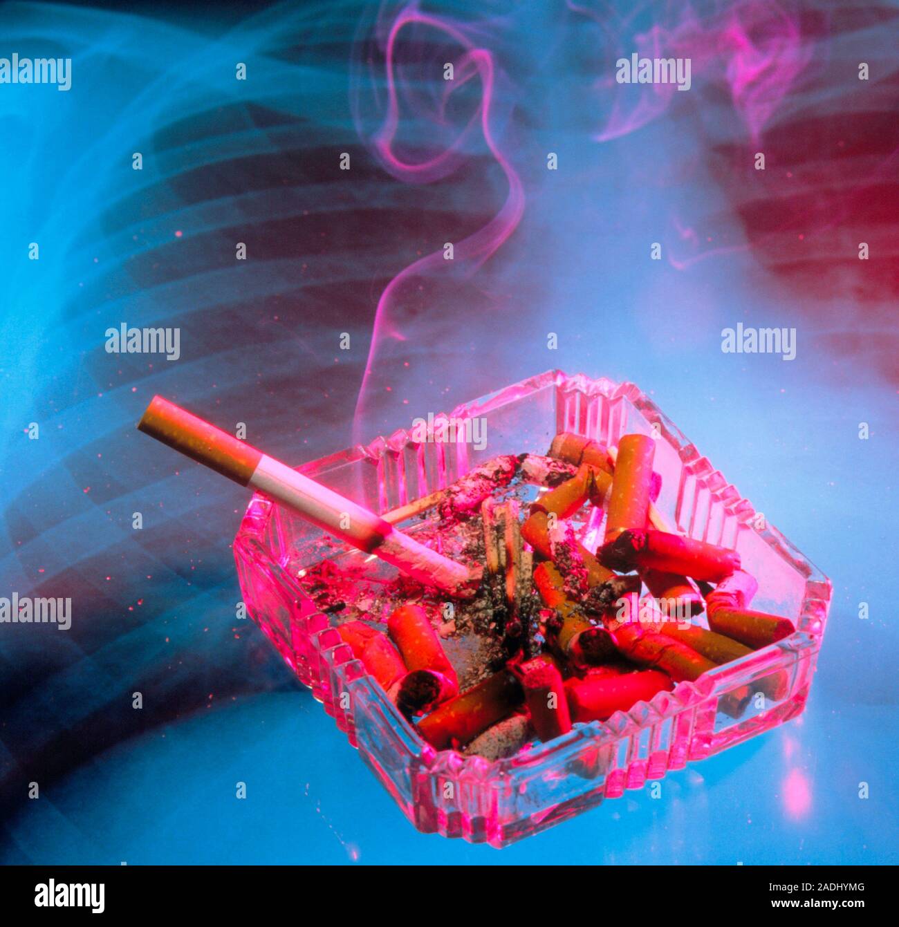 Smoking: full ashtray with X-ray of lungs in the background Stock Photo ...