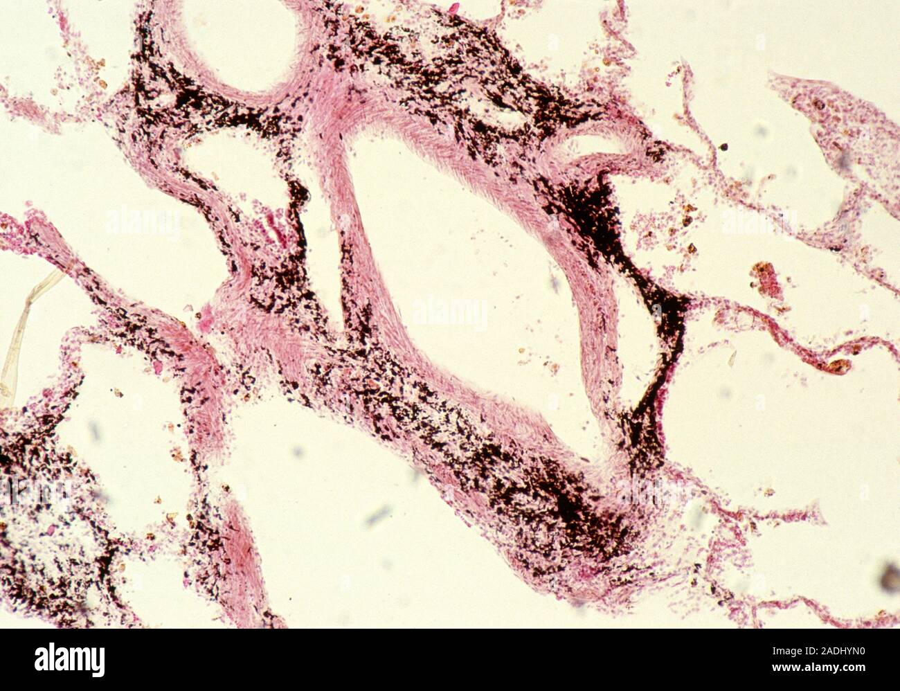 Light micrograph of a smoker's lung. This field of pulmonary alveoli ...