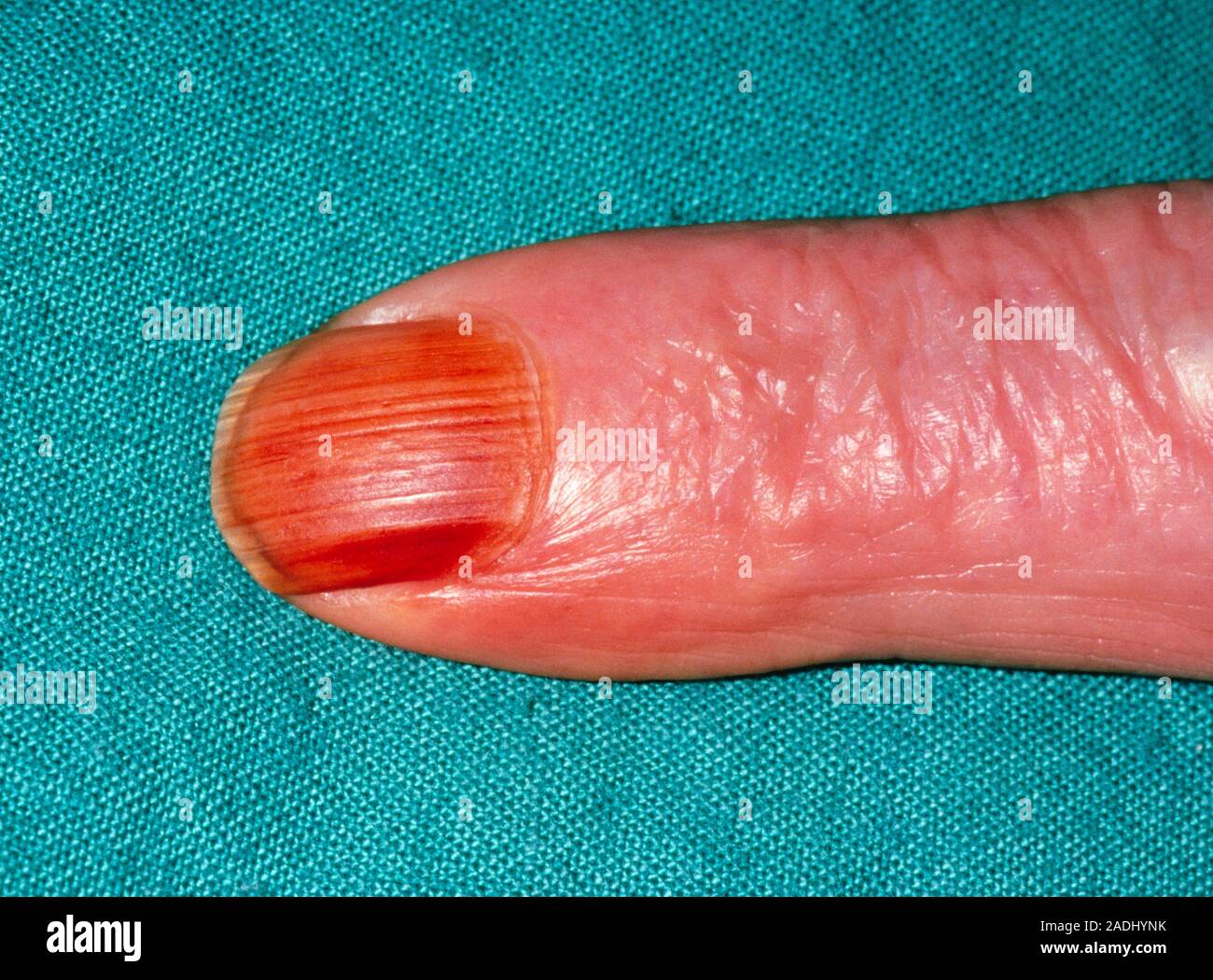 Nicotine stain. View of the brown tar-stained fingernail of a cigarette ...
