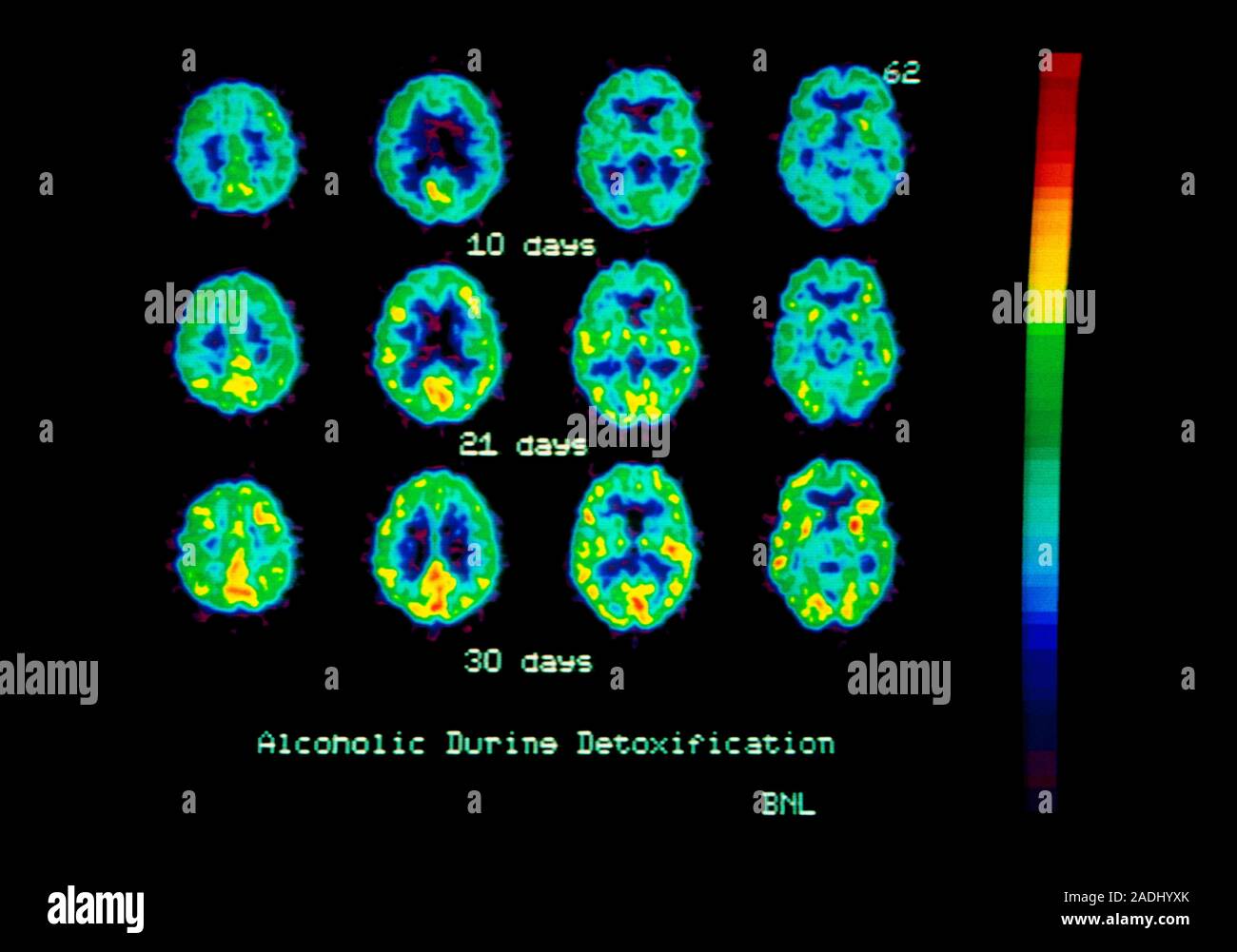 Alcohol And Depression Brain Scan