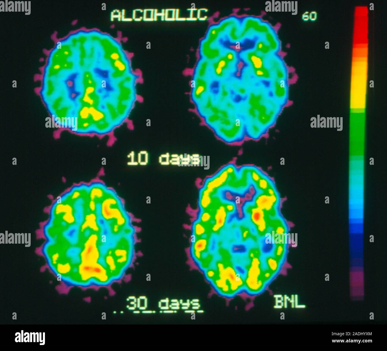 Alcohol withdrawal. Coloured positron emission tomography (PET) scans ...