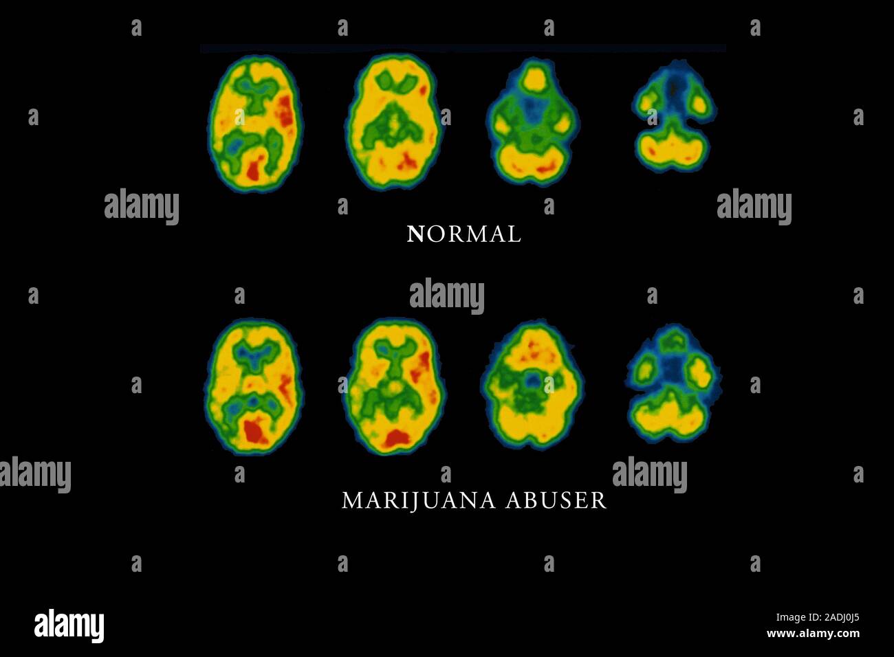 Marijuana brain scans. Coloured positron emission tomography (PET ...