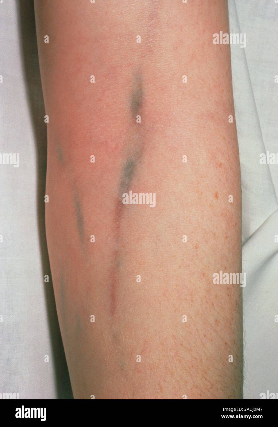 Injection tracking marks in drug addict. View of the arm of a heroin ...