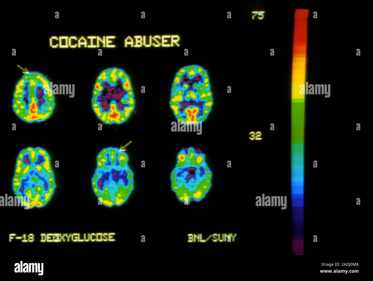 Cocaine brain activity. Coloured positron emission tomography (PET ...