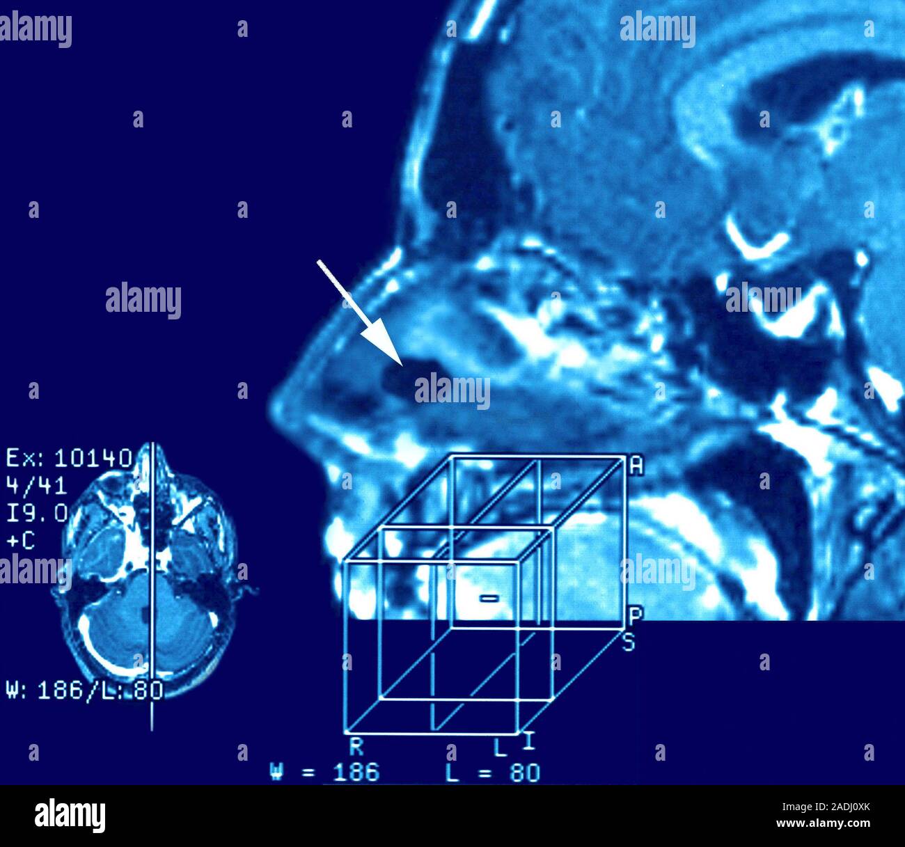 Cocaine damaged nasal septum. Magnetic resonance imaging (MRI) scan of ...