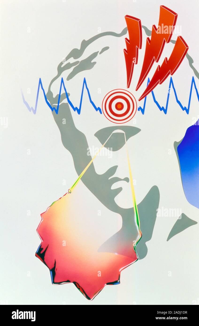 Scotoma in migraine. Abstract illustration of a migraine headache and ...