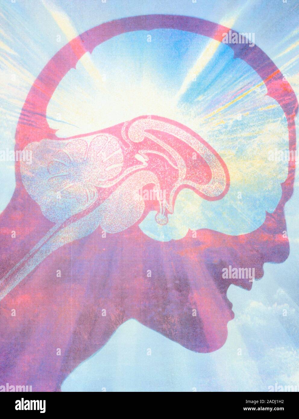 Headache. Artwork of a sagittal slice through the brain over a face in ...