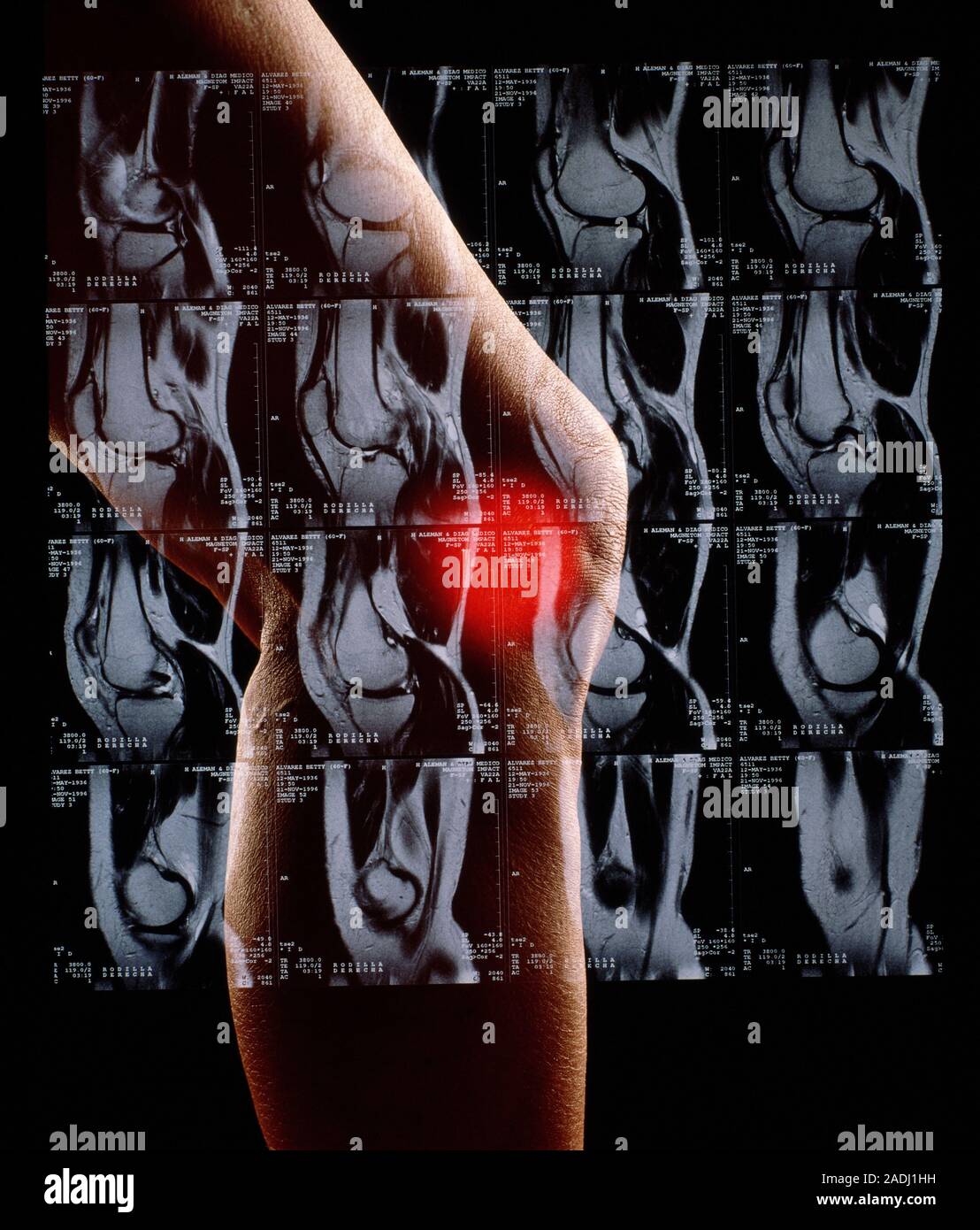 Knee pain. Side view of a woman's knee, with a red area depicting pain ...