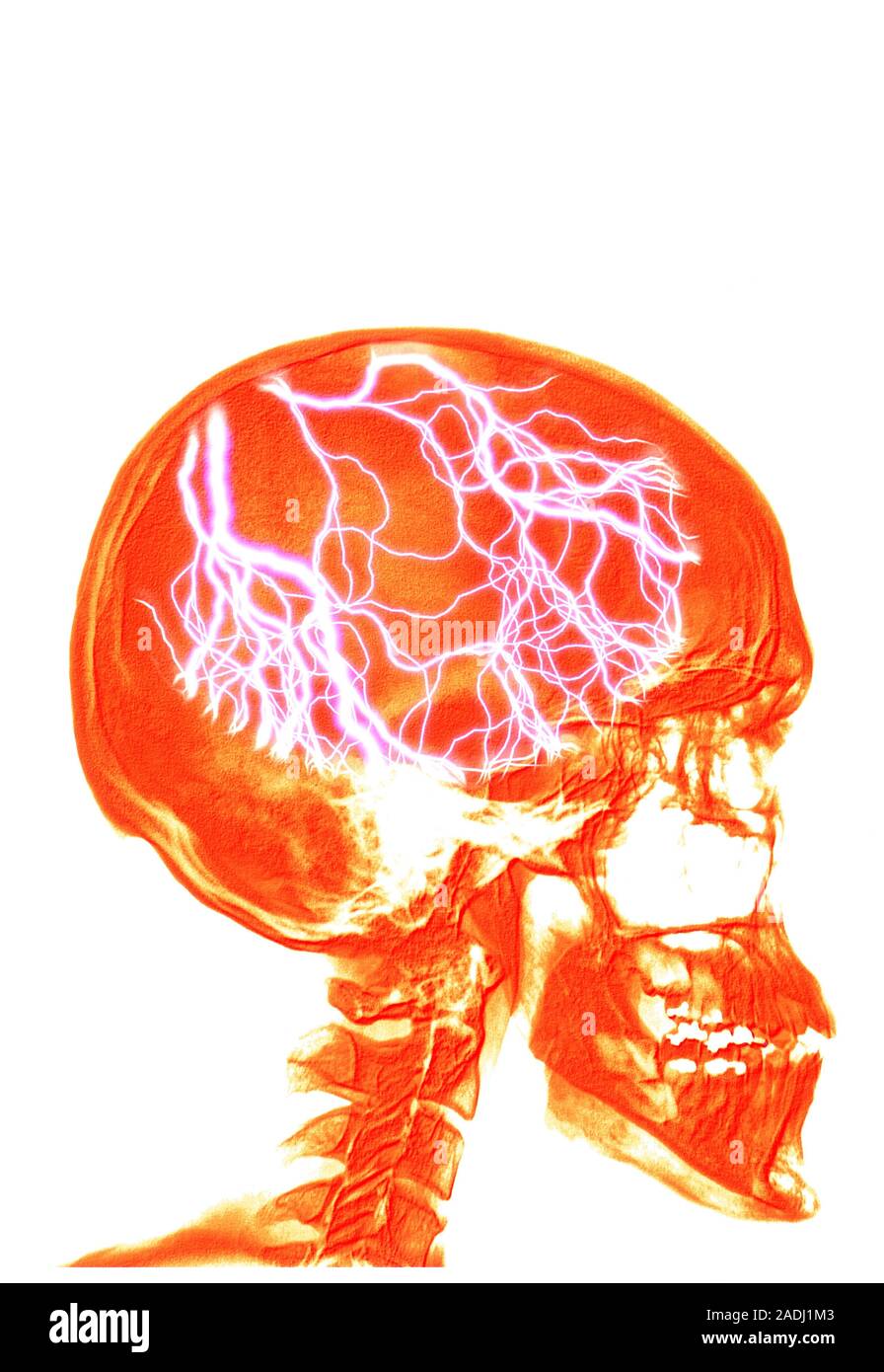 Headache. Conceptual composite image of lightning superimposed on an X ...