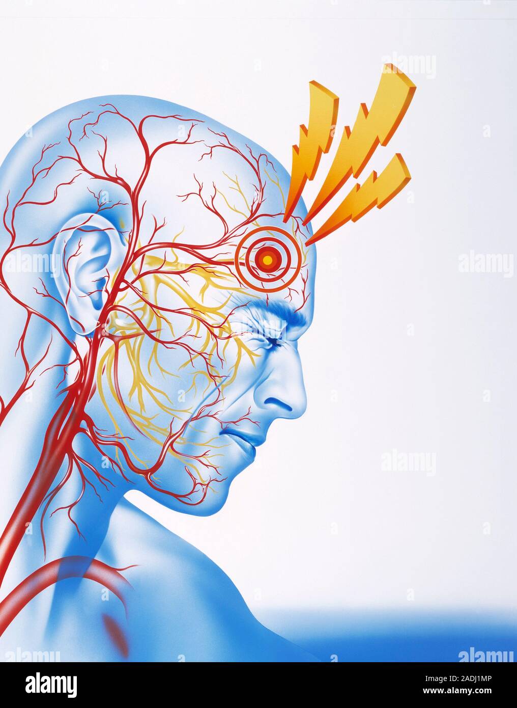 Migraine. Conceptual artwork of lightning flashes marking the epicentre ...
