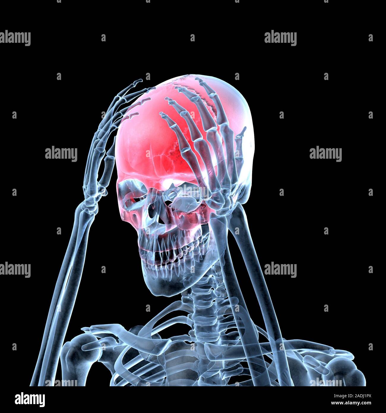 Headache, computer artwork. Skeleton holding its head in pain. The red ...